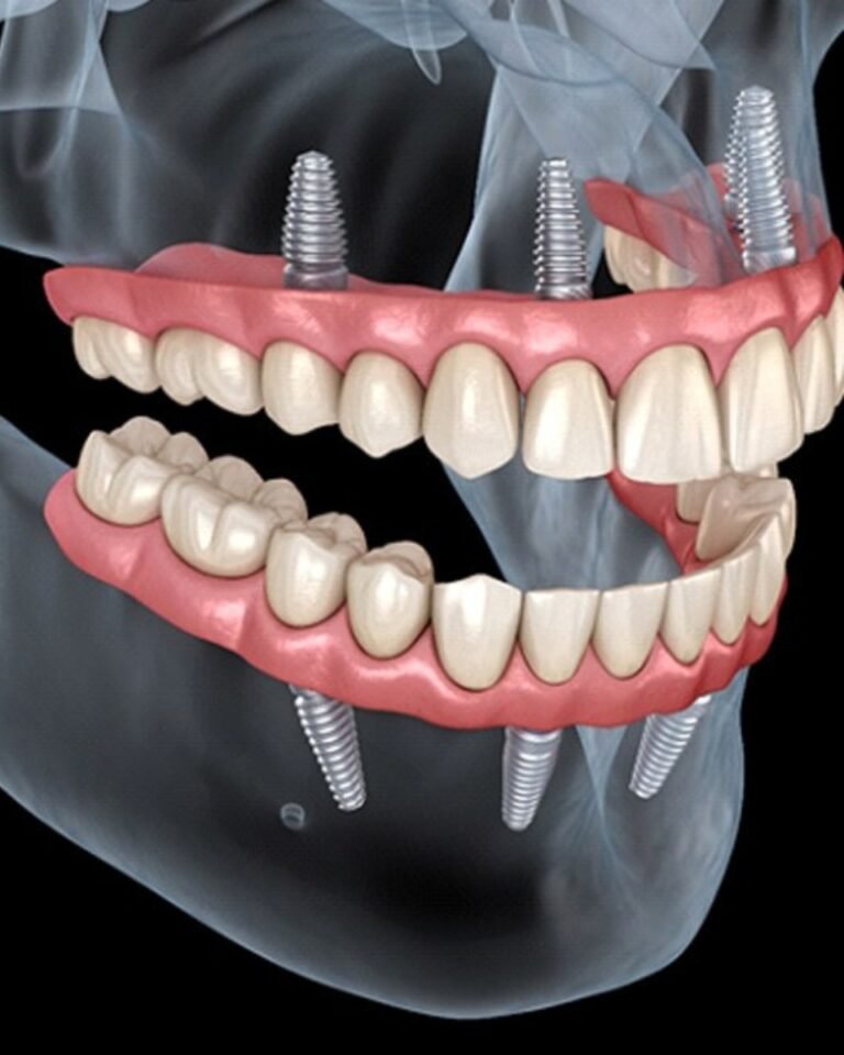 All-On-4 Dental Implants Edinburgh - Full Mouth Implants